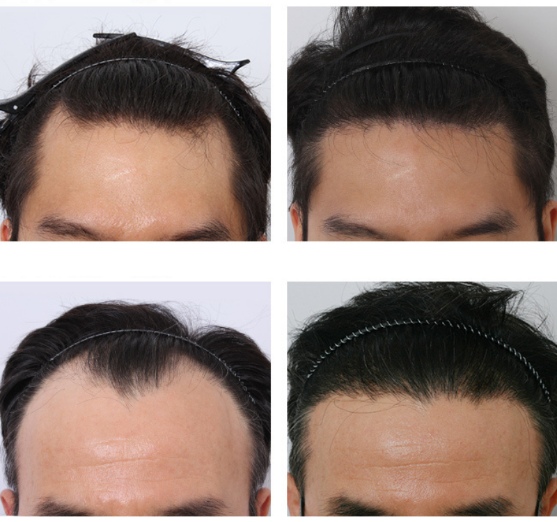 Hairline correction - Maxwell Hair Clinic