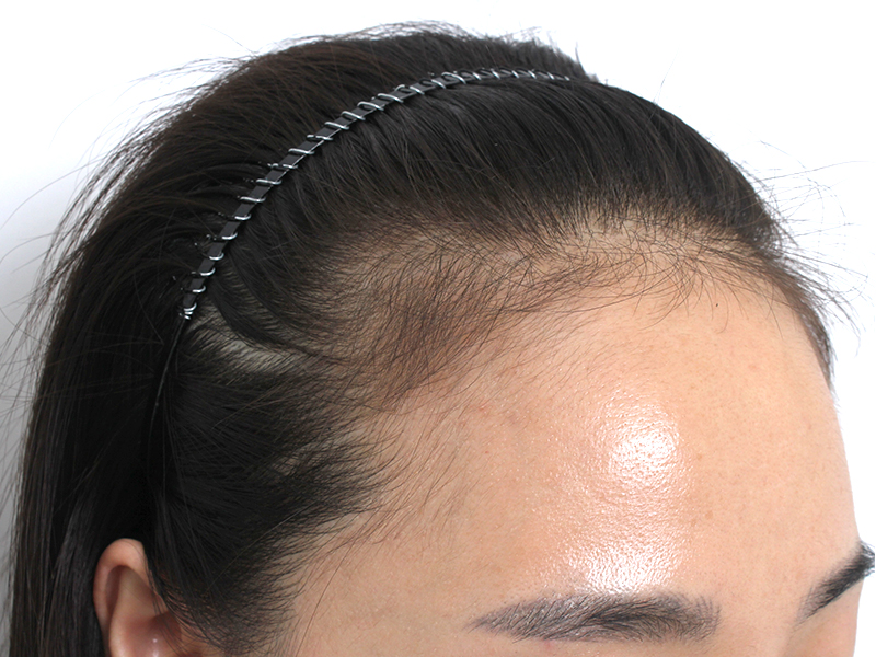 Hairline correction - Maxwell Hair Clinic