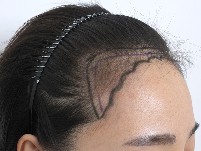 Hairline correction - Maxwell Hair Clinic